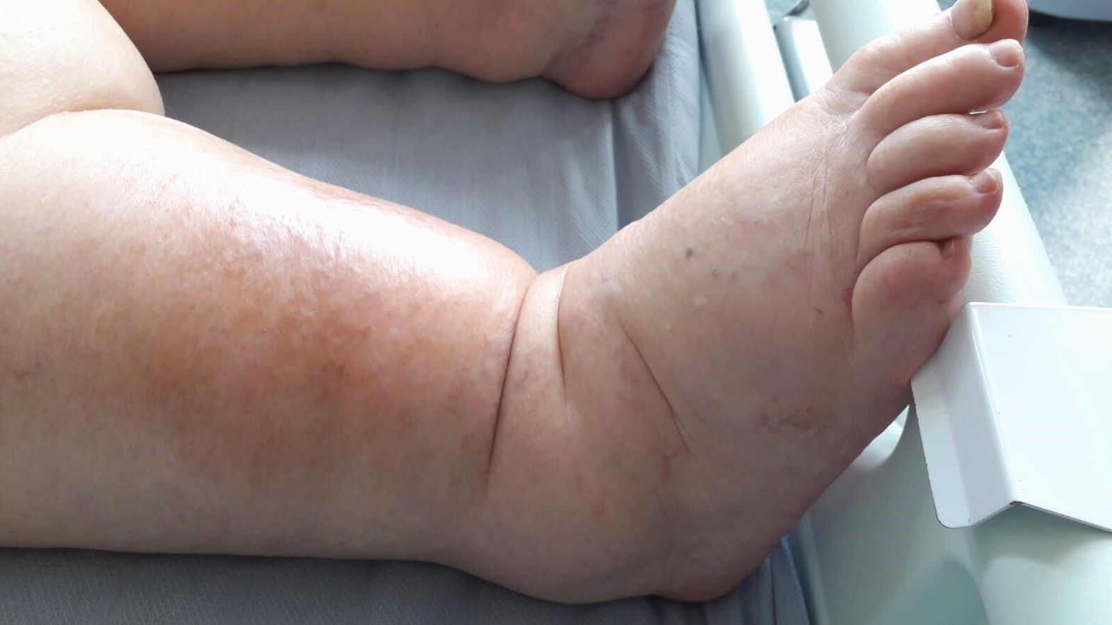 What is Oedema | Oedema Bariatric Socks | Interweave Textiles